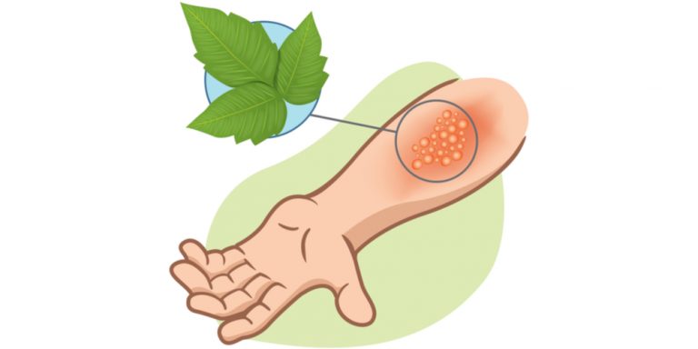 English Ivy vs. Poison Ivy: Similarities and Differences